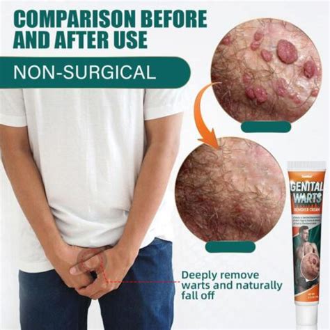 Sumifun Genital Wart Removal Cream Relieve Discomfort Fast Hot E0 Ebay