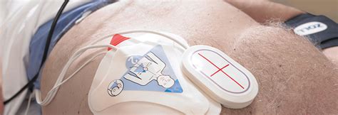 Defibrillator Pad Placement Zoll Medical