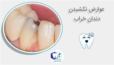 عوارض نکشیدن دندان خراب مهراز کارت