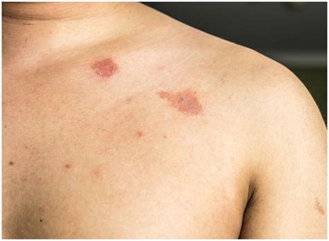 Butenafine Hydrochloride Vs Clotrimazole Health Guide Net