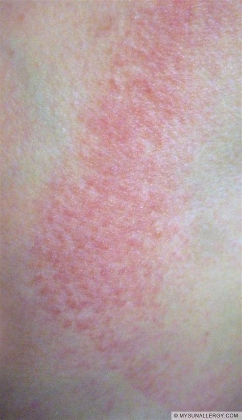 Polymorphous Light Eruption Pmle Pictures And Sun Allergy Rash Images
