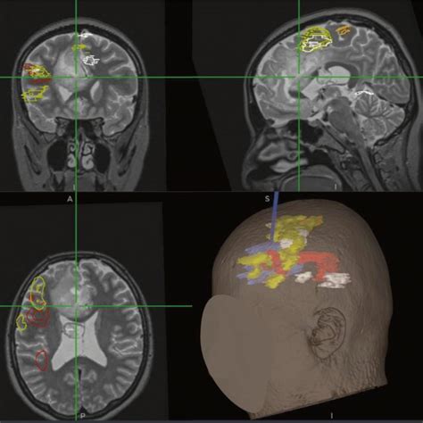 Midsagittal Brain View Showing Critical Interhemispheric Cortical Download Scientific Diagram
