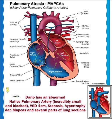 His Rare Case Of Chd Tetralogy Of Fallot Tof With Pa And Mapcas His Rare Case Of Chd Tetralogy Of Fallot Tof With Pa And Mapcas