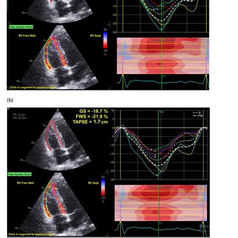Ventilation Perfusion Mismatch Panel A Ventilation Perfusion Download Scientific Diagram