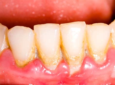 Pregnancy And Periodontitis Key Insights Into Their Correlation