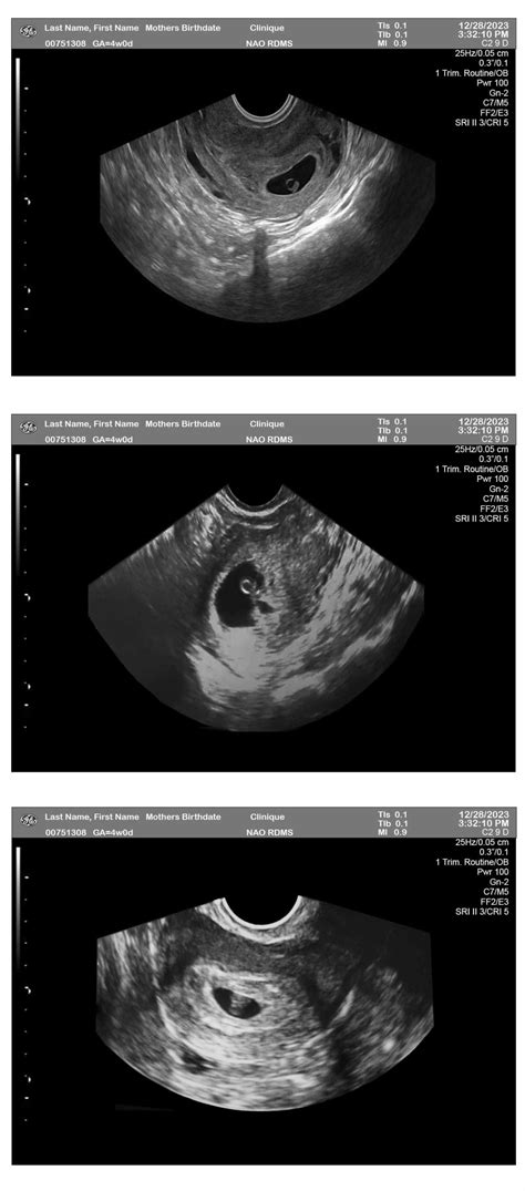 4 Week Sonogram 3 Fetuses Ultrasounds