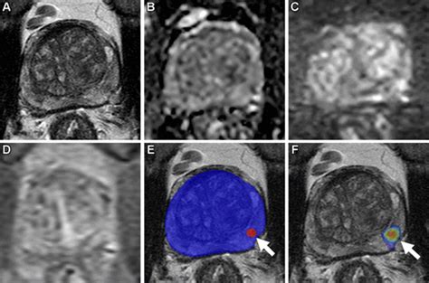 evaluation of a cascaded deep learning based algorithm for prostate