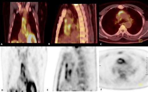 Pet Ct Scan For Vasculitis At Richard Austin Blog