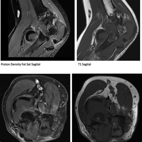 Mri Of The Left Elbow 3 Years After Initial X Ray Pd Fs And T1w Download Scientific Diagram