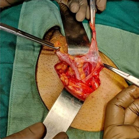 Non Inflamed Vermiform Appendix In The Sac Corresponding To Type 1 Download Scientific Diagram