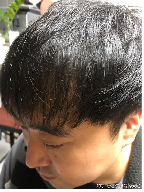 亲身经历讲讲植发恢复期的4个阶段 知乎