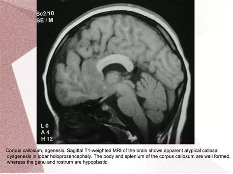 Congenital Malformations Of Brain Ppt