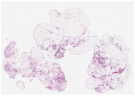 5 Ischemia And Necrosis Histopathology Atlas