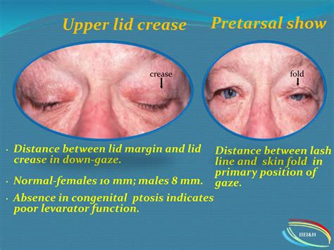 Ptosis Workup Pptx