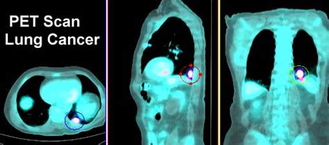 Stage 4 Lung Cancer Xray