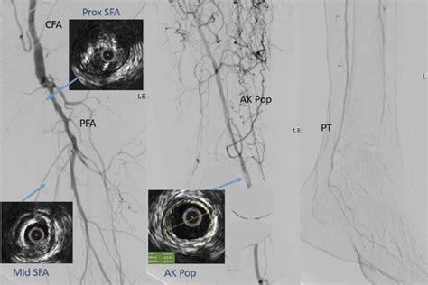 Achieving Success In Calcified Sfa And Popliteal Lesions Endovascular Today