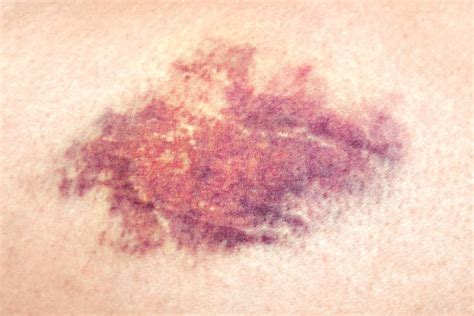 What Are The Symptoms Of Low Platelet Count And The Treatment For Low