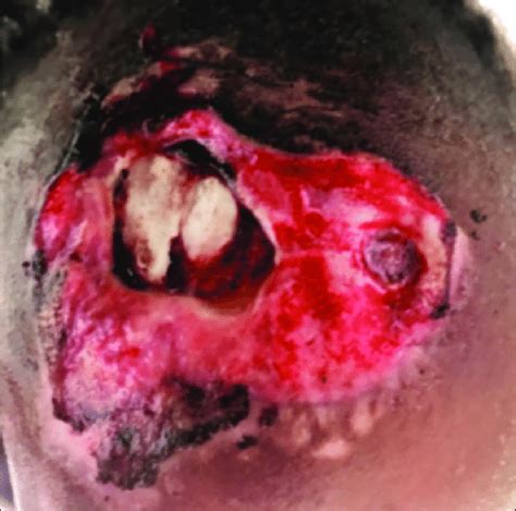 A Large Sized Scalp Laceration 10 Cm × 6 Cm With Exposed Bone 4 Cm ×