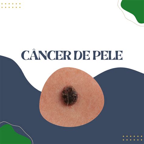 Quais São Os Tipos De Câncer De Pele Cursau Educação Blog