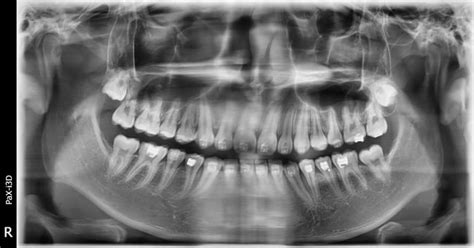 Condyle Resorption R Tmj