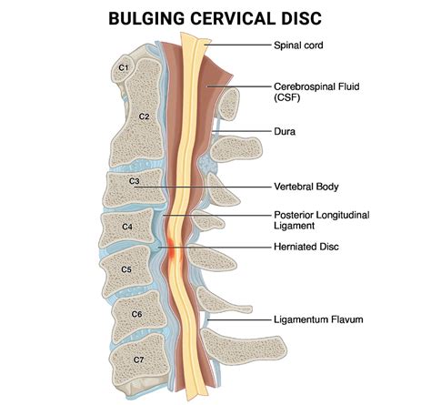 Cervical Disc Herniation C3 C4