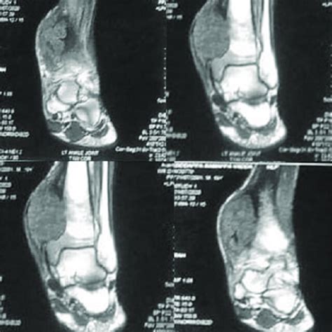 T2 Hypointense Spindle Shaped Mass Involving Metaphysis Of Tibia