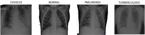 [論文レビュー] Chest Disease Detection In X Ray Images Using Deep Learning Classification Method