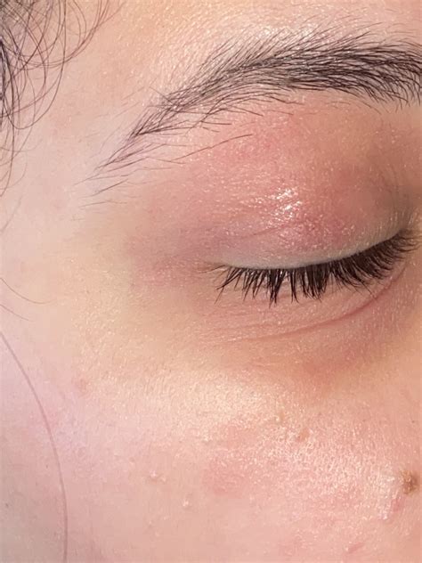 Лишеи на лицето и около очите Профилактика Мнения от Bg Mamma