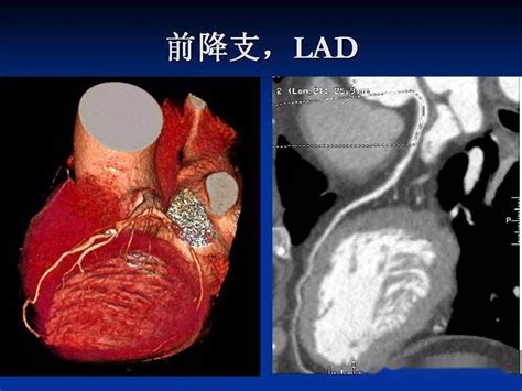 冠脉ct图片讲解解剖图 千图网