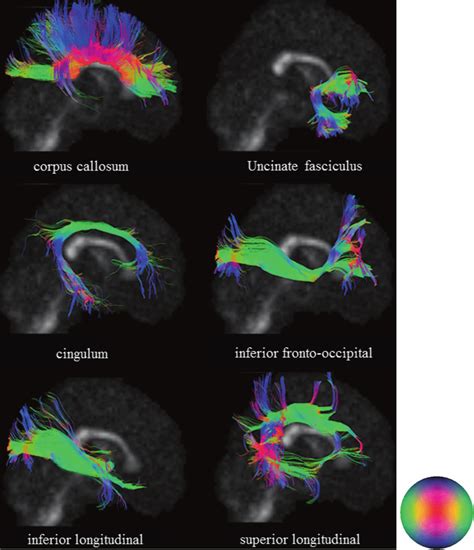 2 Six Classic White Matter Tracts Obtained With Dsi Tractography