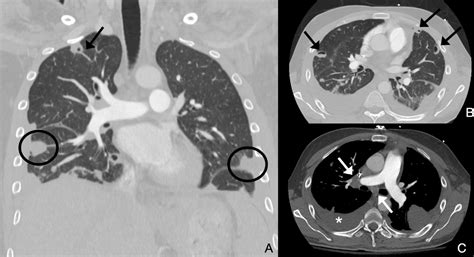 Figure 1 From Computed Tomography Findings In Septic Pulmonary Embolism