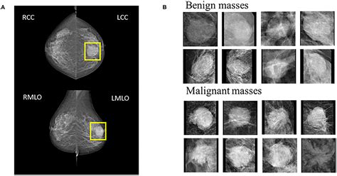 Benign And Malignant Tumors What Is The Difference