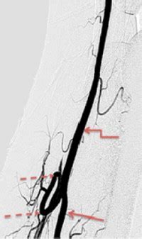 Radial Loop Complete Radial Artery Loop Resulted In Crossover To Ulnar Download Scientific