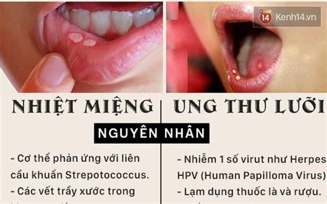 Nhiệt Miệng Và Ung Thư Lưỡi Triệu Chứng Dễ Nhầm Lẫn Làm Thế Nào để Phân Biệt