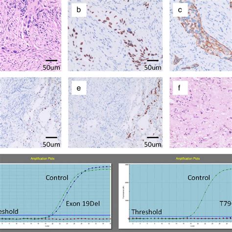Pathology And Amplification Refractory Mutation System Polymerase Chain Download Scientific