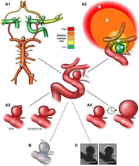 Effects Of Aneurysm