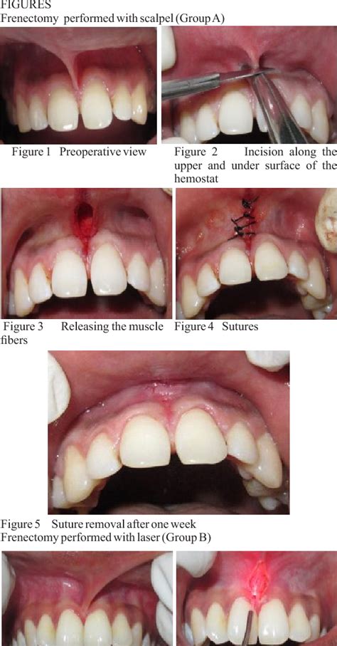 Labial Frenectomy