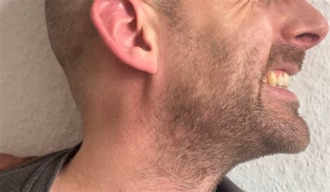 Got Teeth Strong Overbite Fixed In Past Headgear But Now