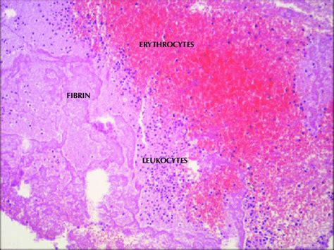 Composition Of A Fresh Thrombus By Optical Microscopy Characterised By