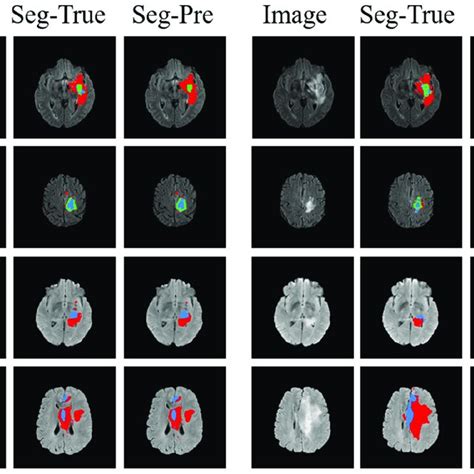 Comparison Of Brain Tumor Segmentation Outputs And Gt Download
