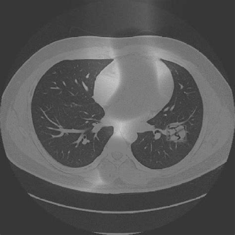 Lung Cancer Classification Model V3 2023 09 02 4 54pm By Unitec