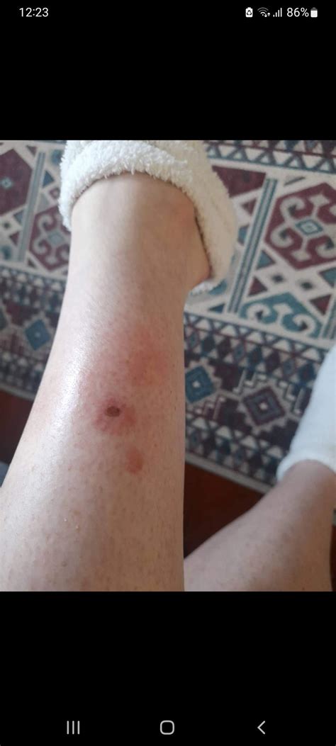 Right So My Sister Woke Up With These Bites Anyone Know What Bit Her