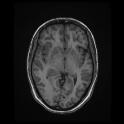 File High Grade Glioma NOS Grade Radiopaedia Axial NC Commons