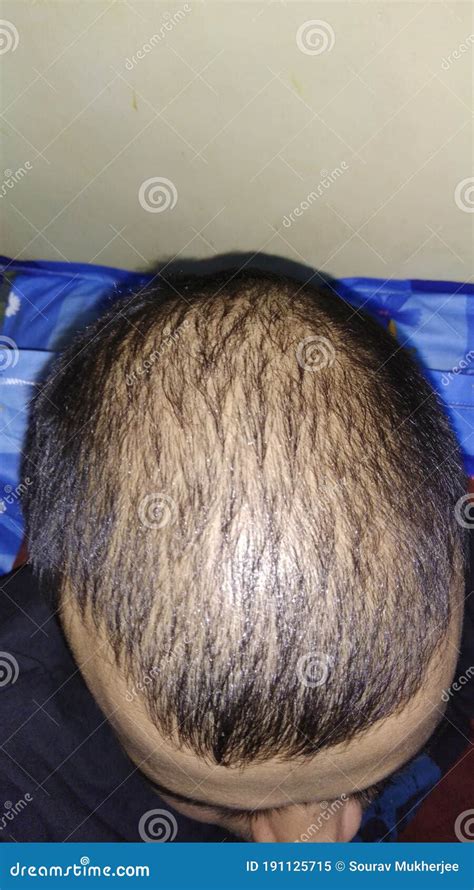 Less Hair In Head Density Of Hair Is Very Low Stock Image Image Of