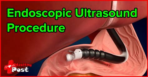 What Is Endoscopic Ultrasound Different From Colonoscopy And Gastroscopy