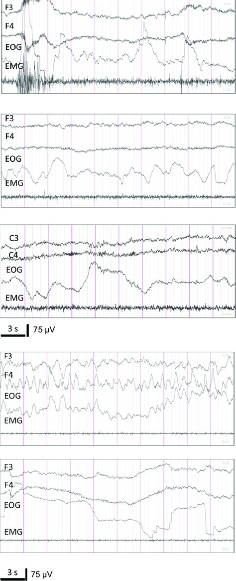 Patterns Of Activity Obtained In Patient 3 Whose Hypnogram Is