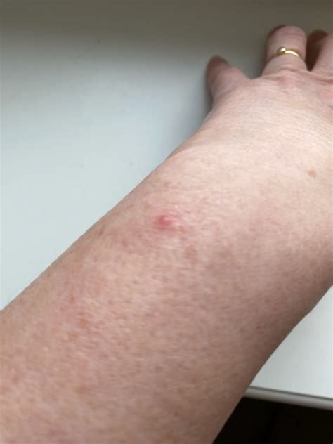 Apple Watch Sensor Burns Apple Community