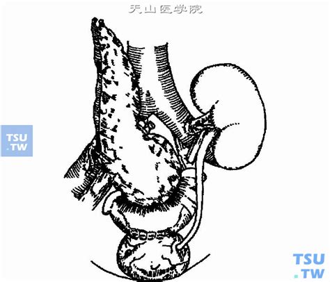 【附图】 胰腺移植手术 糖尿病学 天山医学院