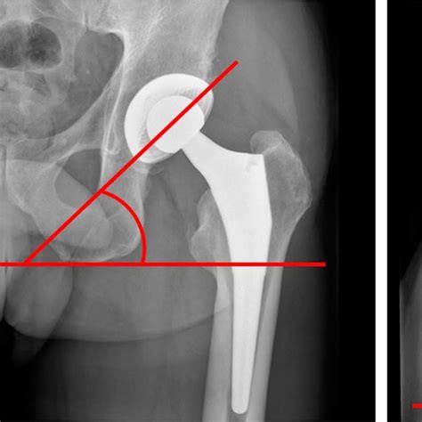 Anteroposterior And Lateral Radiographs Illustrating An Example Of How Download Scientific