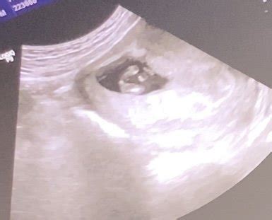 Erro no sexo do bebê BabyCenter